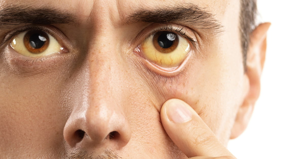 yellowish skin cause