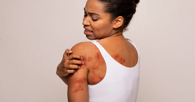 Hives vs. Rash: Decoding the Skin's Distress Signals – Advanced Food ...